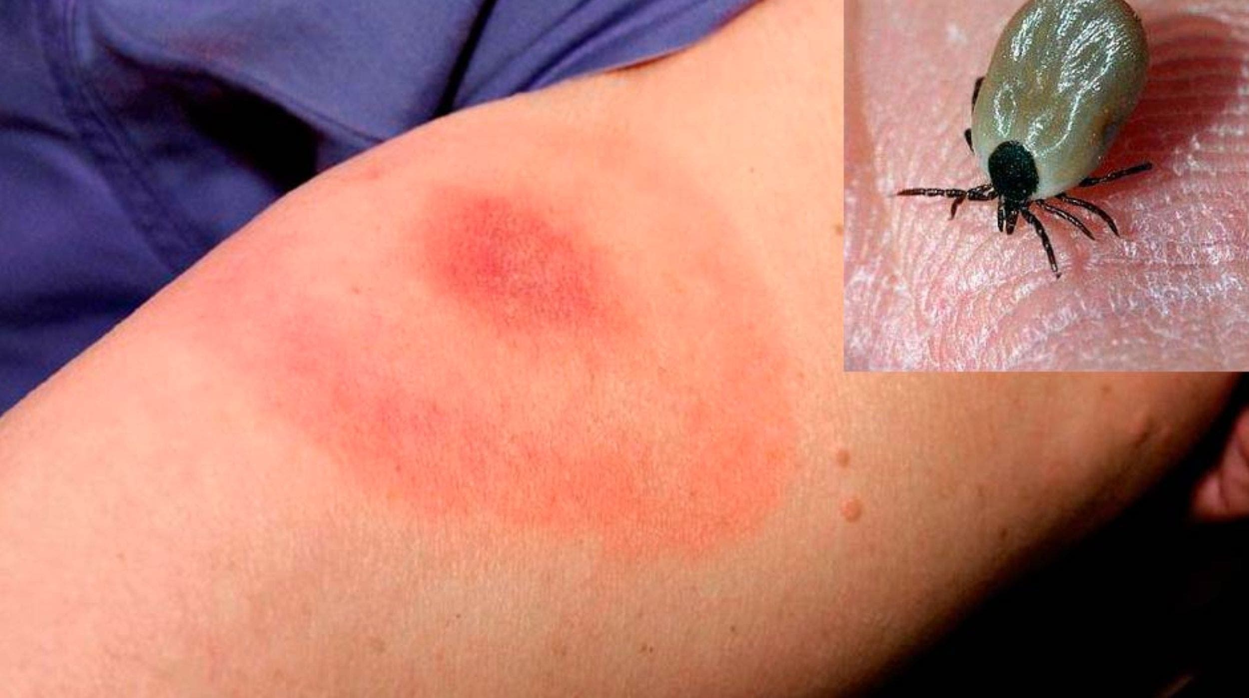 Muere un menor de edad en Torreón a causa de rickettsiosis, tras ...